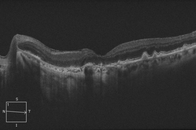 Degeneración macular asociada a la edad (DMAE) – José Gutiérrez Amorós ...