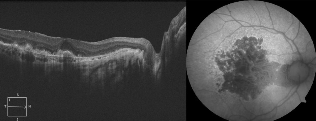 Evolución del tratamiento en Degeneración Macular – José Gutiérrez ...